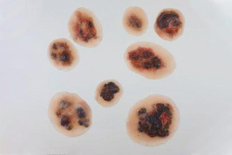 Cutaneous wounds with cancerous melanoma | More Than Simulators