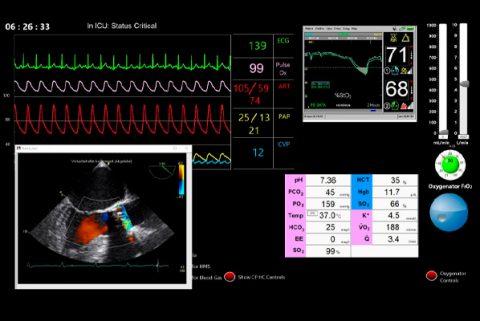 Advanced ECMO and Cardiac Bypass Simulator - CALIFIA | More Than Simulators
