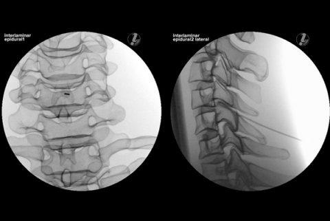 X-RAY IMAGE-GUIDED CERVICAL INJECTION SIMULATOR | More Than Simulators