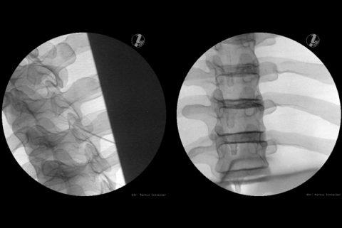 X-ray image-guided thoracic spine injection simulator | More Than ...