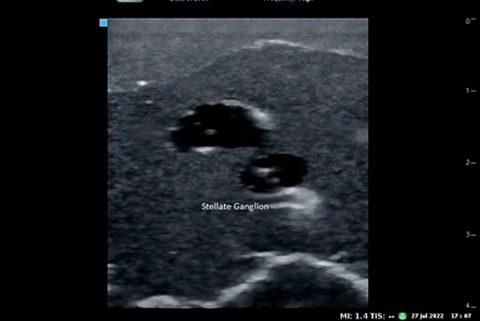 Simulator for jugular venous access and ultrasound-guided nerve blocks ...