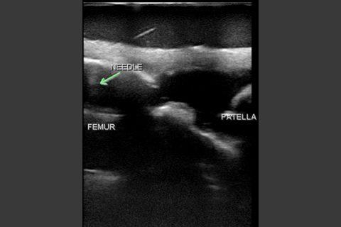 Knee phantom for musculoskeletal ultrasound and ultrasound-guided ...