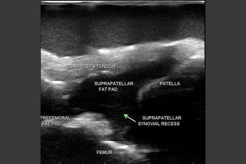 Knee phantom for musculoskeletal ultrasound and ultrasound-guided ...