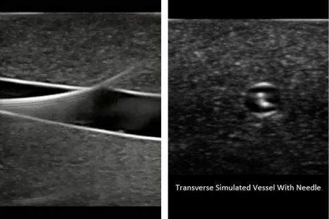 Simulator for femoral access with deep vein thrombosis | More Than ...